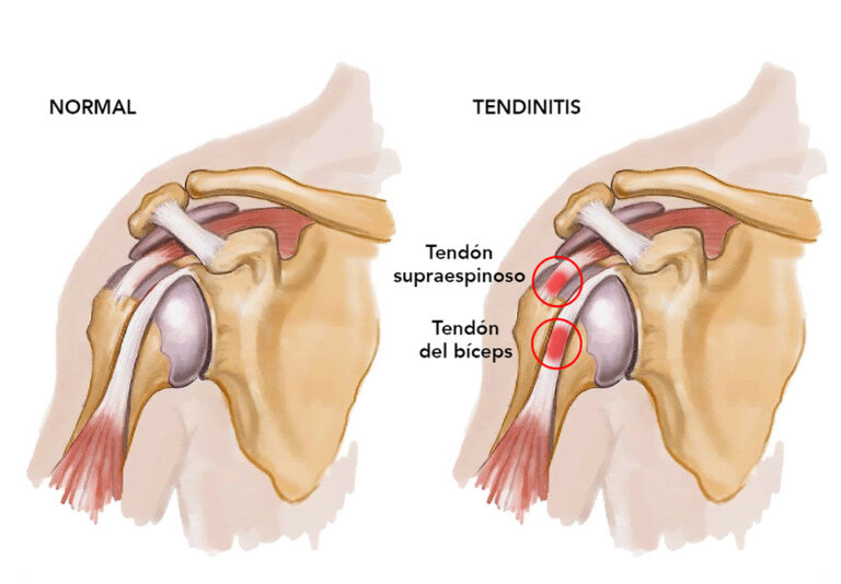 ¿Qué es la tendinitis de hombro? | Clínica DKF